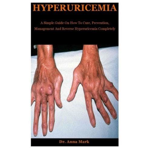 Hyperuricemia: A Simple Guide On How To Cure Prevention Management And ...